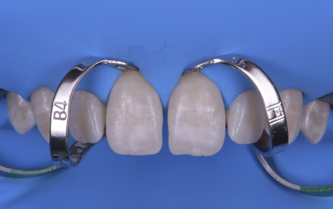 FERMETURE DE DIASTÈME AU COMPOSITE EN TECHNIQUE DIRECTE : LA « FRONT ...