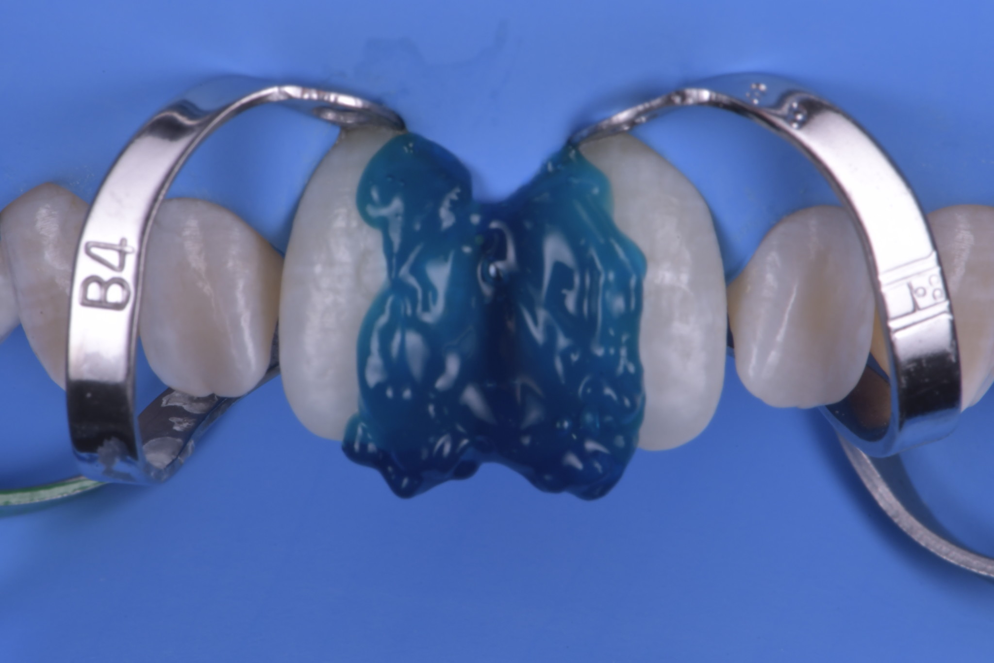 FERMETURE DE DIASTÈME AU COMPOSITE EN TECHNIQUE DIRECTE : LA « FRONT ...