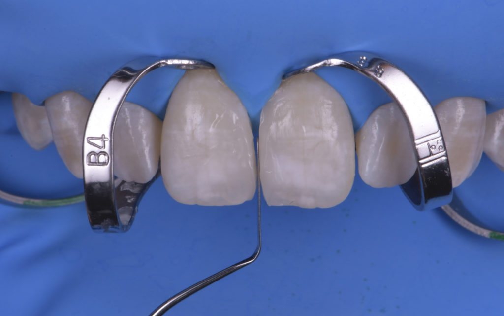 FERMETURE DE DIASTÈME AU COMPOSITE EN TECHNIQUE DIRECTE : LA « FRONT ...