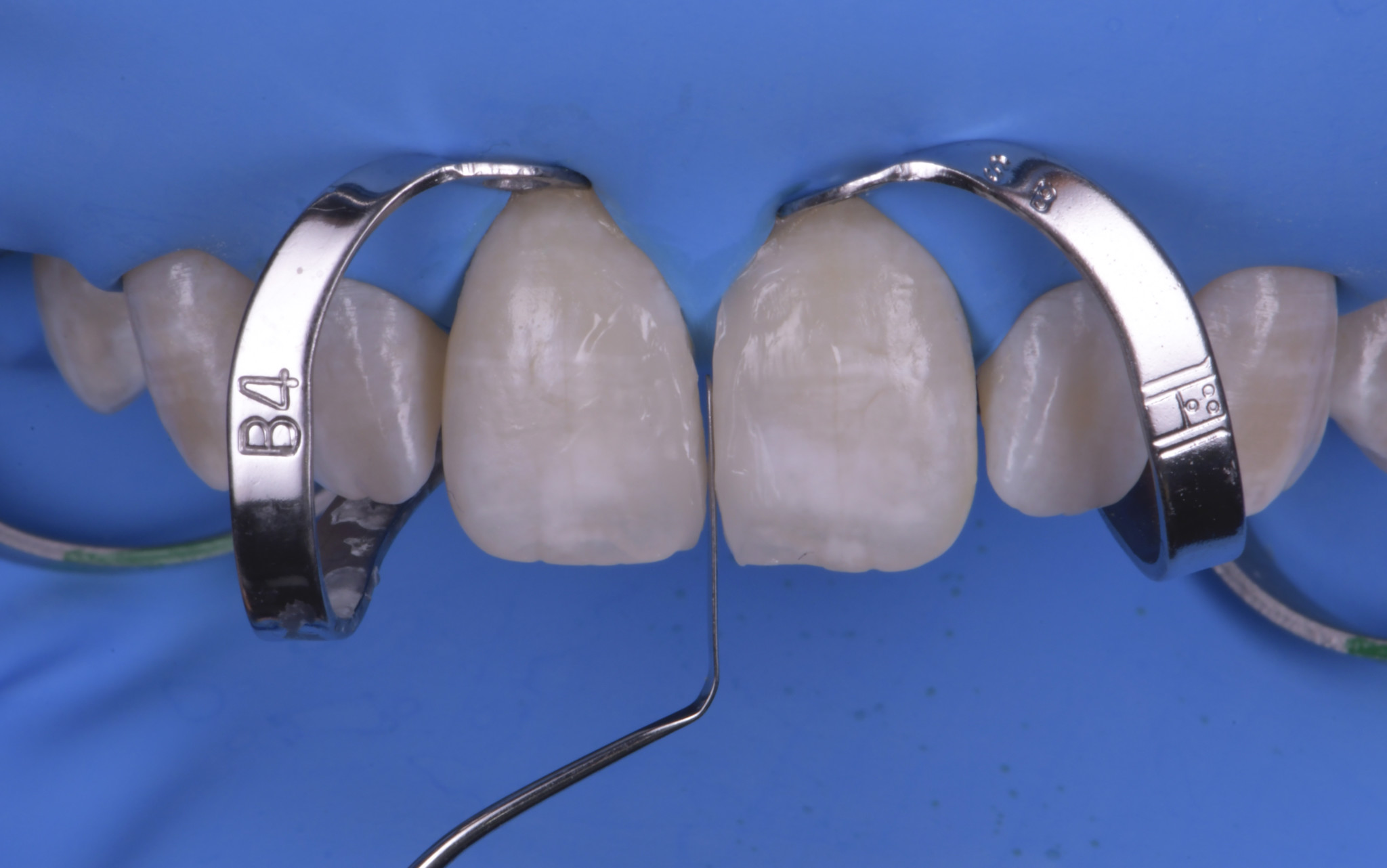 FERMETURE DE DIASTÈME AU COMPOSITE EN TECHNIQUE DIRECTE : LA « FRONT ...