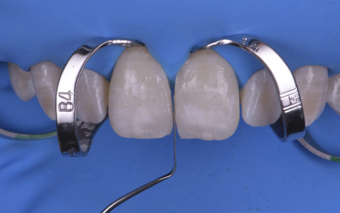 FERMETURE DE DIASTÈME AU COMPOSITE EN TECHNIQUE DIRECTE : LA « FRONT ...