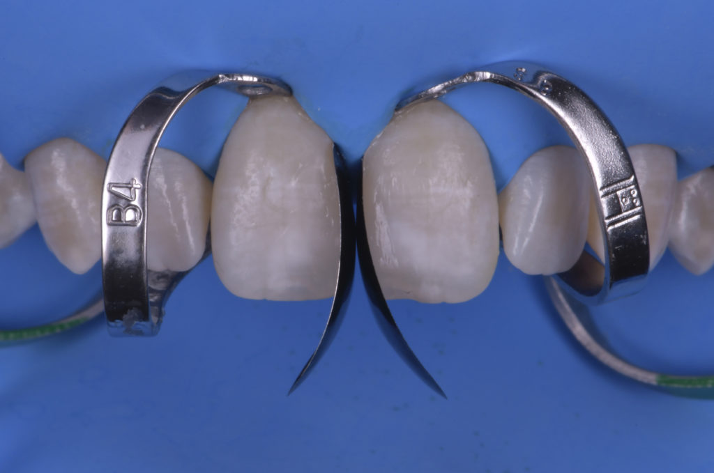 FERMETURE DE DIASTÈME AU COMPOSITE EN TECHNIQUE DIRECTE : LA « FRONT ...