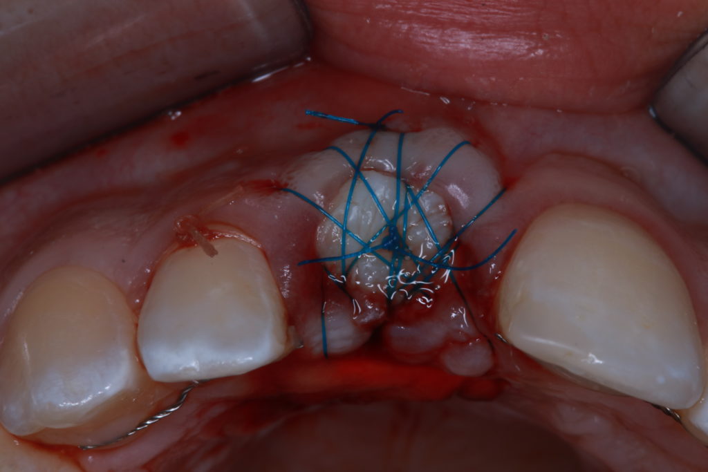 PRÉSERVATION DE L’ALVÉOLE D’EXTRACTION : INDICATIONS, INTÉRÊT ET ...