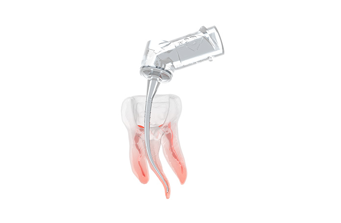 OPTIMISEZ L’IRRIGATION DU CANAL RADICULAIRE AVEC IRRIFLEX ...