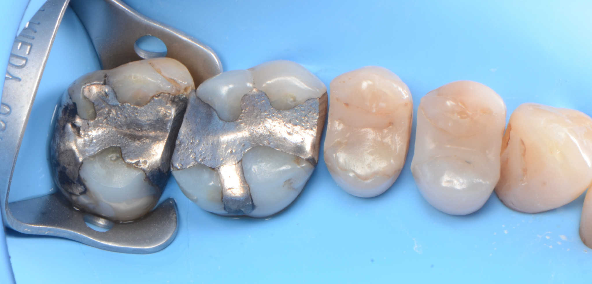 LA PREPARATION D'UNE RESTAURATION ADHÉSIVE SUR DENT FÉLÉE ...