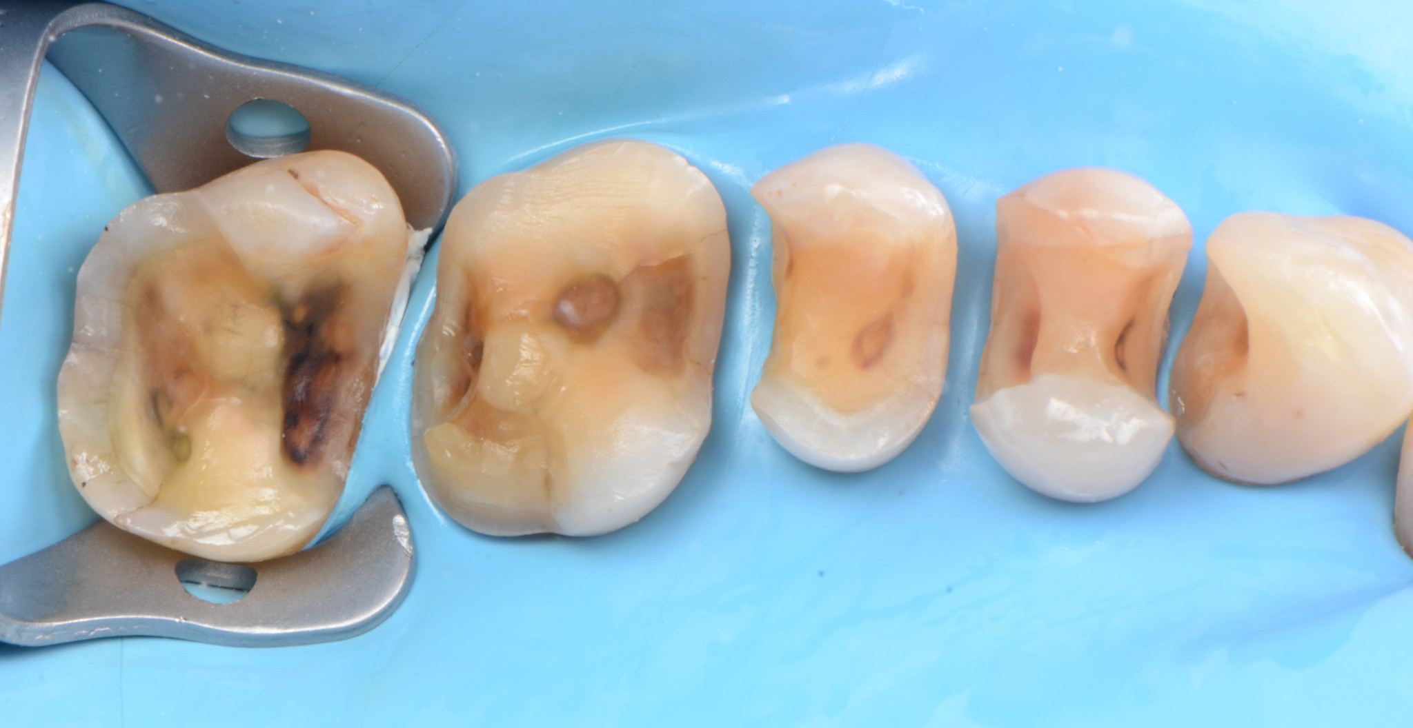 LA PREPARATION D'UNE RESTAURATION ADHÉSIVE SUR DENT FÉLÉE ...