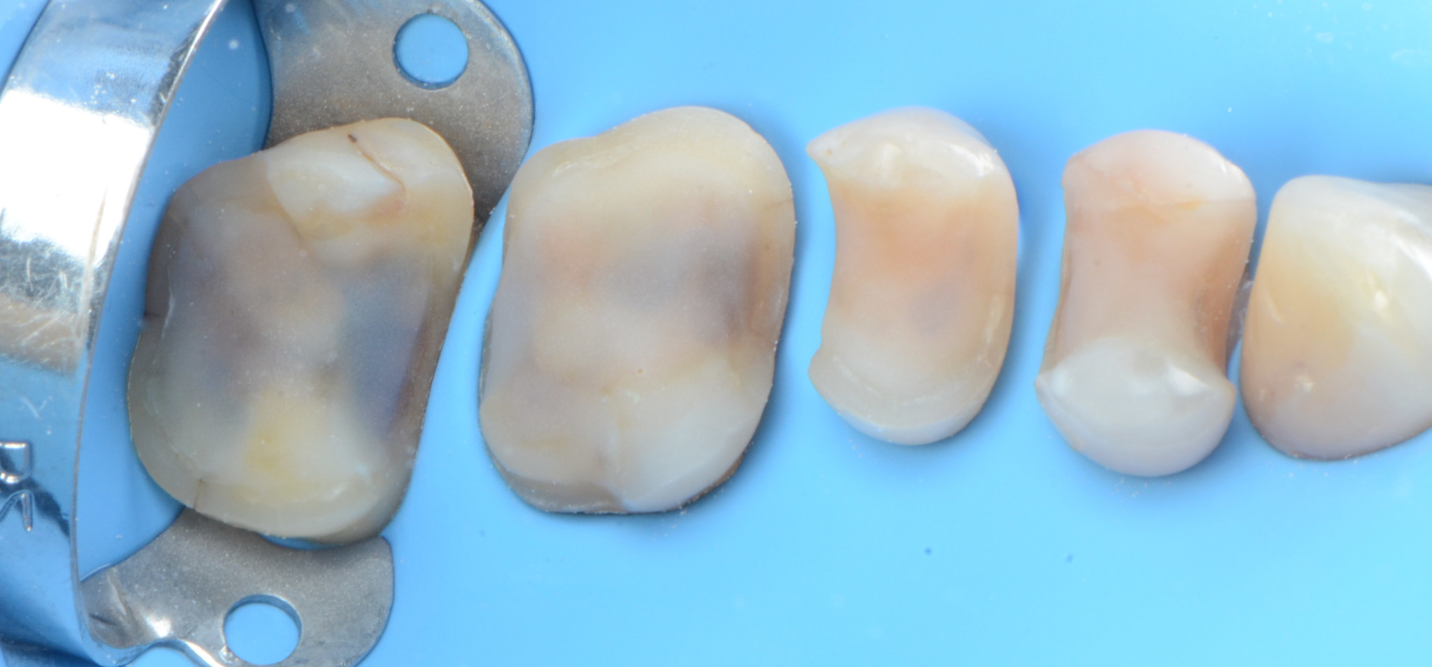 LA PREPARATION D'UNE RESTAURATION ADHÉSIVE SUR DENT FÉLÉE ...