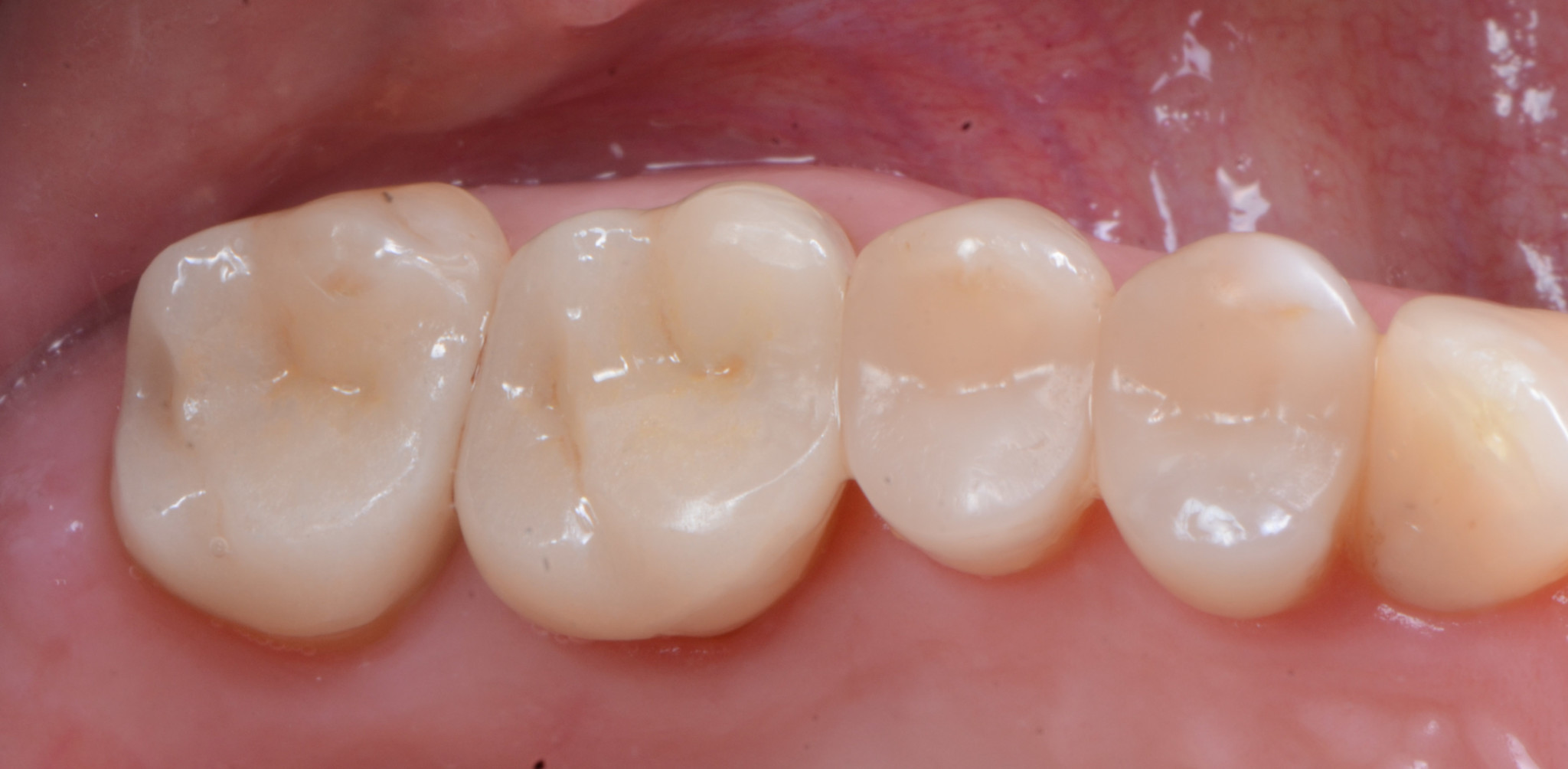 LA PREPARATION D'UNE RESTAURATION ADHÉSIVE SUR DENT FÉLÉE ...