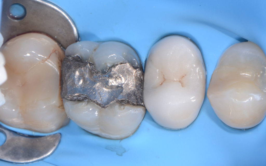 LA PREPARATION D'UNE RESTAURATION ADHÉSIVE SUR DENT FÉLÉE ...