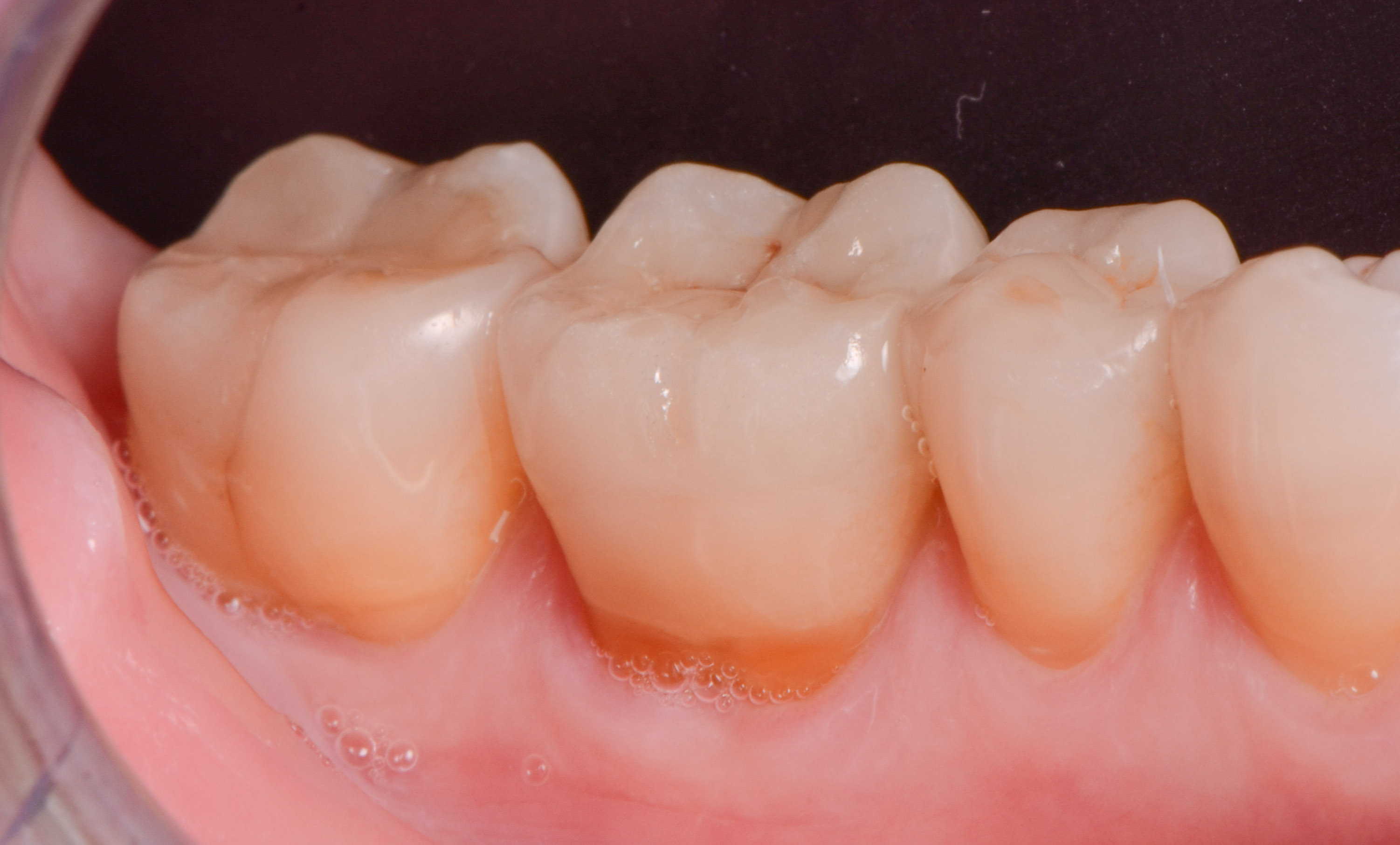 LA PREPARATION D'UNE RESTAURATION ADHÉSIVE SUR DENT FÉLÉE ...